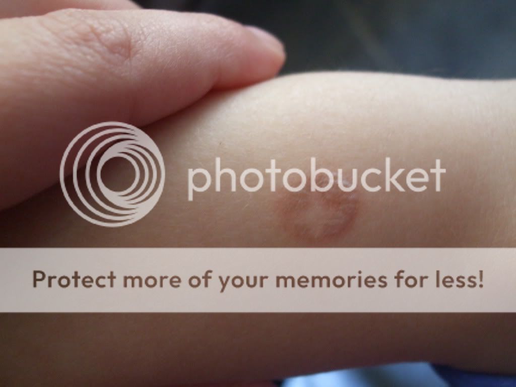 Ringworm or burn * pictures* ? | BabyCenter